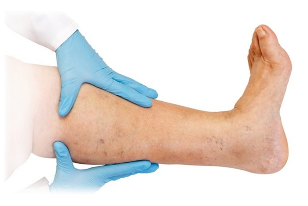 Uncovering the Vascular Causes of Leg Pain and Swelling | Washington ...