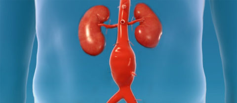 Abdominal Aortic Aneurysms (AAA) | Washington Vascular