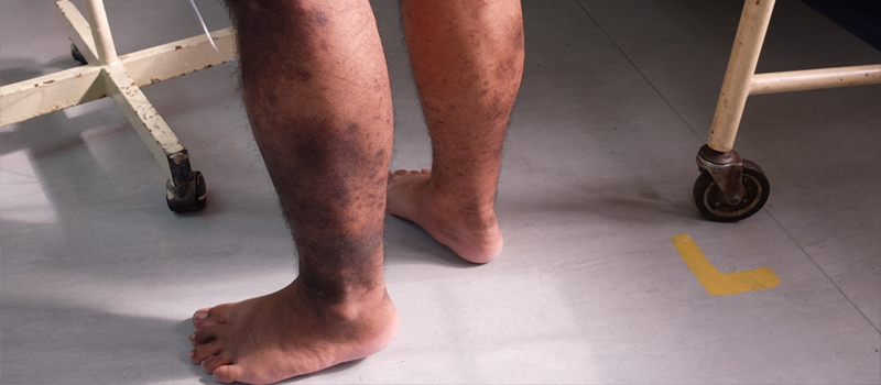 Chronic Venous Insufficiency | Washington Vascular
