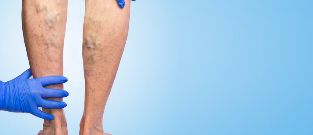 Varicose Veins | Washington Vascular