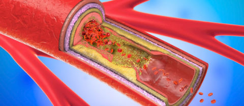 Carotid Artery Disease | Washington Vascular