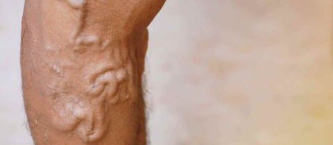 Varicose Vein | Washington Vascular