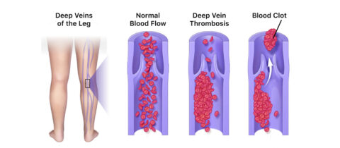 Deep Vein Thrombosis | Washington Vascular