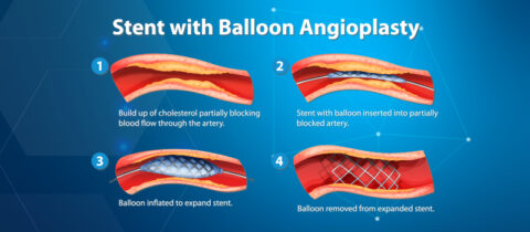 Carotid Artery Disease (CAD) | Washington Vascular